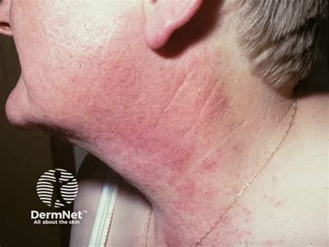 Drug Induced Photosensitivity Dip Images— Dermnet