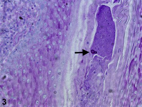 Verrucous Plaque On The Face Jaad Case Reports