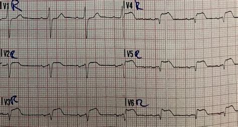 Acute St Elevation Myocardial Infarction Stemi Of Anterior Wall Icd 10 Design Talk