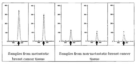 Genes For Prognosis Of Cancer Eureka Patsnap