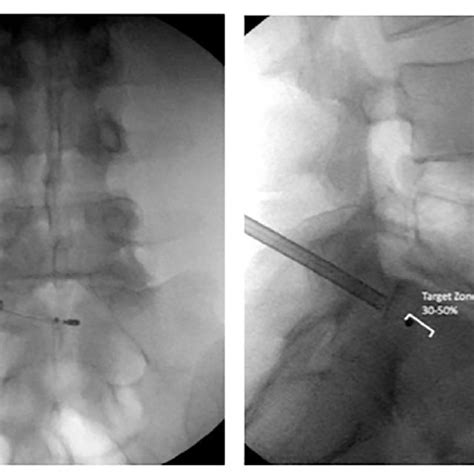 Detailed Definitions Of Grading Classification The Pfirrmann Grading Download Scientific