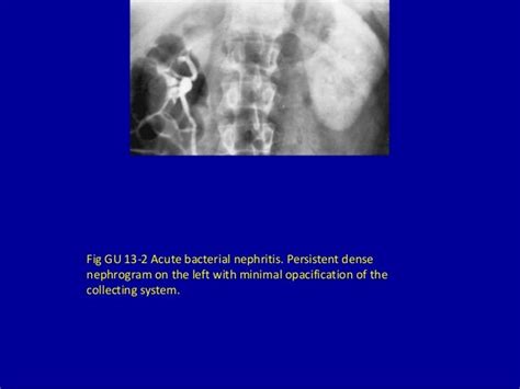 13 Persistent Or Increasingly Dense Nephrogram