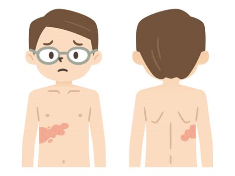 90 Shingles Rash Stock Illustrations Royalty Free Vector Graphics