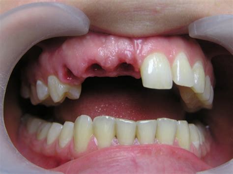 Restoration Of Defect In The Frontal Portion Alpha Dent Implants