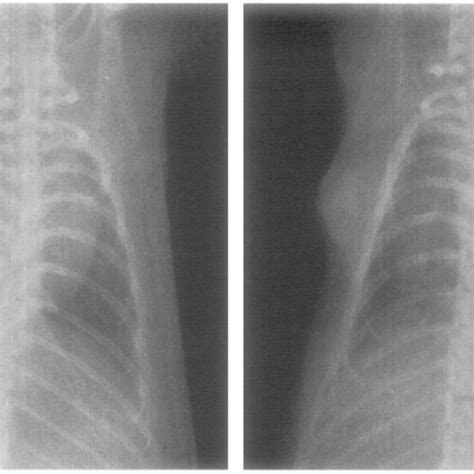 Chest Radiographs Of Nontolerant Left And Tolerant Right Lung Download Scientific Diagram