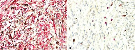 Spindle Cell Uveal Melanoma A Diffuse Moderately Positive Hmb45 Download Scientific