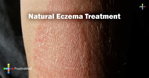 Natural Eczema Treatment Positivemed