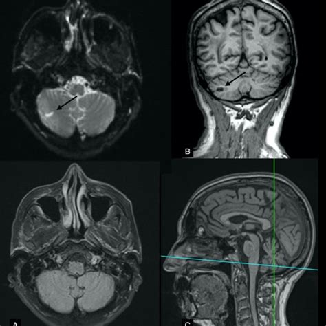 Time Of Flight Tof Angiography A Hypoplastic P1 Segment Belonging To Download Scientific