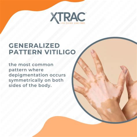 Strata Skin Sciences On Linkedin Vitiligo Generally Appears In One Of