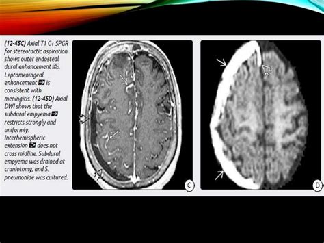 Cns Infections Bacterial And Viral 1 Pptx
