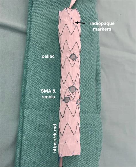 Physician Modified Endovascular Graft Pmeg Rk Md