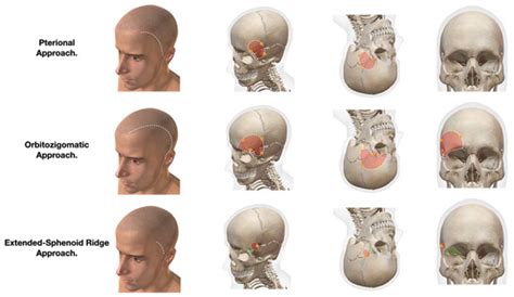 The Extended Sphenoid Ridge Approach A New Technique For The Surgical