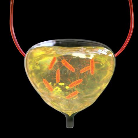 Cystitis Bakterielle Infektion Der Harnblase Konzeptionelle 3d