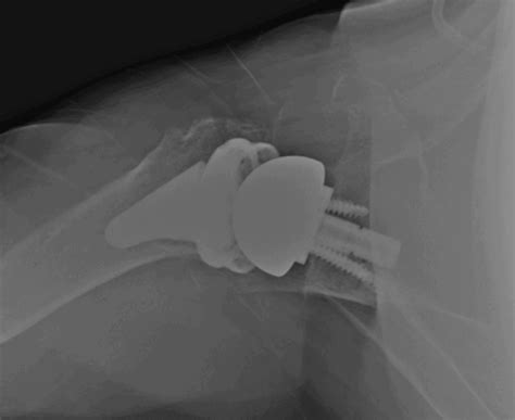 Arthrex Apex American Shoulder And Elbow Surgeons
