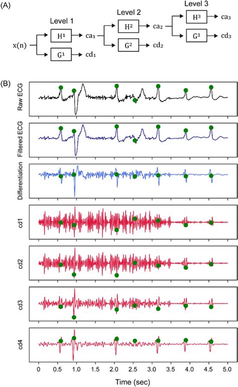 Robust R Peak Detection In An Electrocardiogram With Stationary Wavelet Transformation And