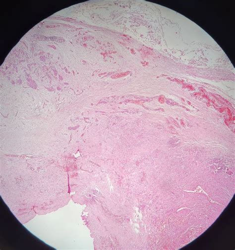 Shahram Sabeti On Linkedin Anterior Cervical Cyst In A 39 Years Old Lady Clinical Impression