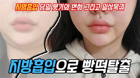 ♥지방 흡입 후기♥ 이중턱 지흡 과정부터 일상복귀까지 싹 다 알려드립니다 Youtube