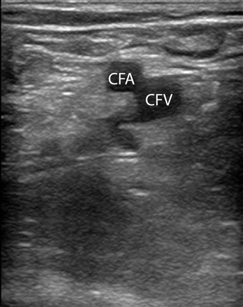 Dvt Ultrasound Made Easy Step By Step Guide Pocus 101