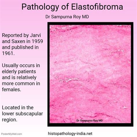 Pathology Of Elastofibroma Softtissuepathology Dermatopathology