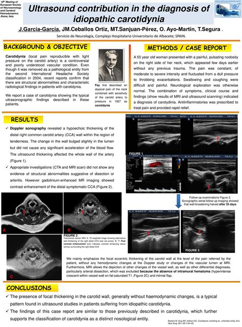 Ultrasound Contribution In The Diagnosis Of Idiopathic Carotidynia
