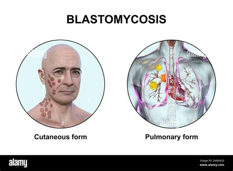 3d Illustration Showing Two Clinical Presentations Of Blastomycosis