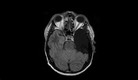 Arachnoid Cyst Mri Radiology Article On Arachnoid Cyst