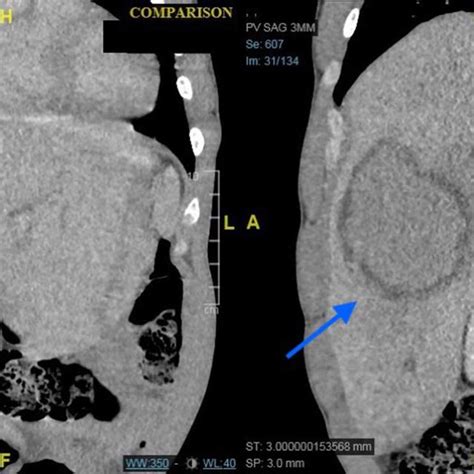 Computed Tomography Angiogram Showing Active Arterial Extravasation
