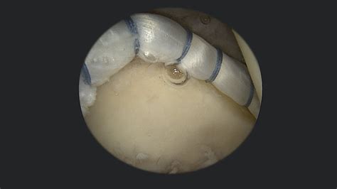 Arthrex Labral Reconstruction With Graft Pull Through Method Using