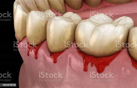 잇몸 이나 치주 출혈 잇몸과 뼈 지원의 병리학적 염증 상태 치과 3d 일러스트레이션 피에 대한 스톡 사진 및 기타 이미지 피 디지털 생성 이미지 박테리아 Istock