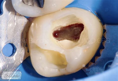 Single Session Endo Resto Treatment Of An Upper Second Molar Style