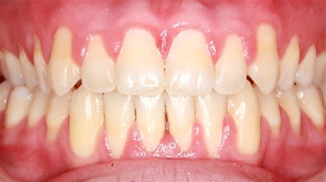 Open Bite Dental Before And After Gallery