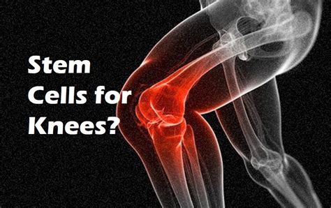 Stem Cells For Knees CSC Regenerative Orthopedics