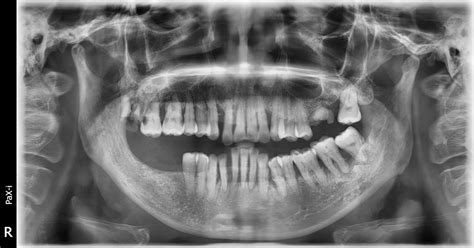 First Clinical Perio Case Any Tips For Me R Askdentists