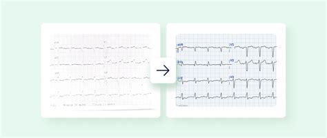 How To Improve The Quality Of An Ecg Instantly With Examples — Powerful Medical
