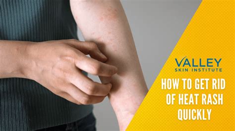 Can Heat Rash Scab At David Rachael Blog