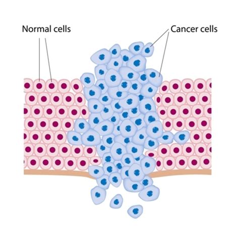 Lung Cancer Lung Cancer Causes Genetics