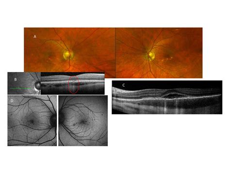 White Dot Syndromes Series Part 3 Punctate Inner Choroidopathy Optometry Advisor