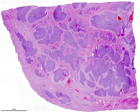 Pathology Outlines Low Grade Endometrial Stromal Sarcoma