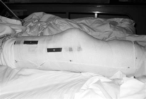 Removable Immediate Post Operative System Moving Forward
