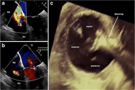 Mitraclip System Application In The Tricuspid Valve Representative