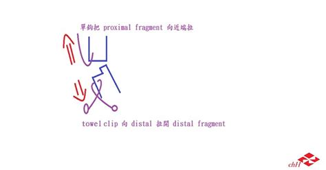 骨科醫師 謝醇樺 拇趾外翻：微創切骨矯正手術 Modified Mitchell Osteotomy