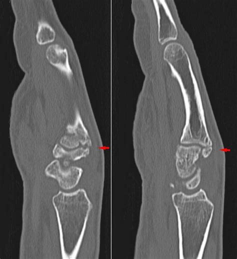 Carpal Boss Wrist Treatment Consultation Surgery Ali Phillips