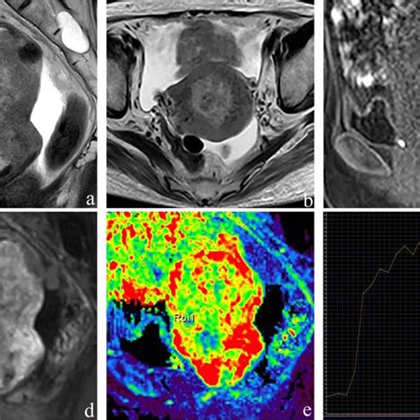 Mri Images A Sagittal T2 Weighted Image Shows That The Uterus Was