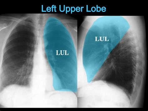 Atelectasis And Collapse In Cxr