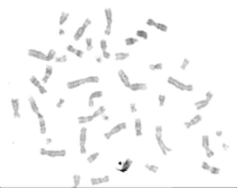 Figure Showing A G Banding Metaphase Of Normal Female Download