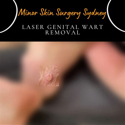 Laser Genital Wart Removal And Treatment Sydney Dr Peter Kim Surgery