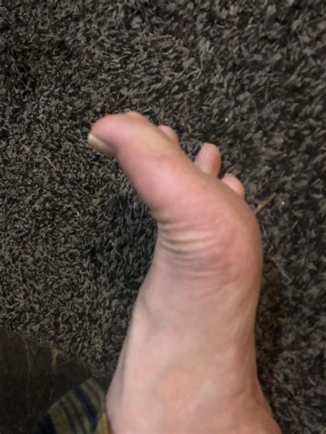 Progress On Biologic Rpsoriasis