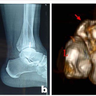 A 36 Year Old Male Patient With Pilon Fracture Of The Right Tibia Download Scientific Diagram