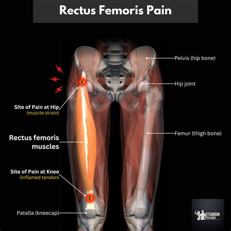 Rectus Femoris Tendonitis Symptoms