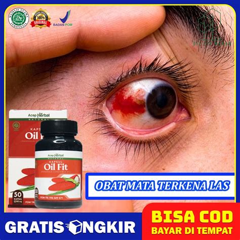 Jual Obat Mata Terkena Las Habis Ngelas Mata Sakit Kena Asap Las